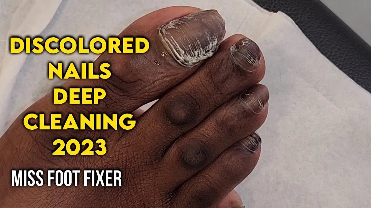 CLEANING TOENAIL 🦶🏽: DISCOLORED TOENAILS DEEP CLEANING BY FAMOUS ...