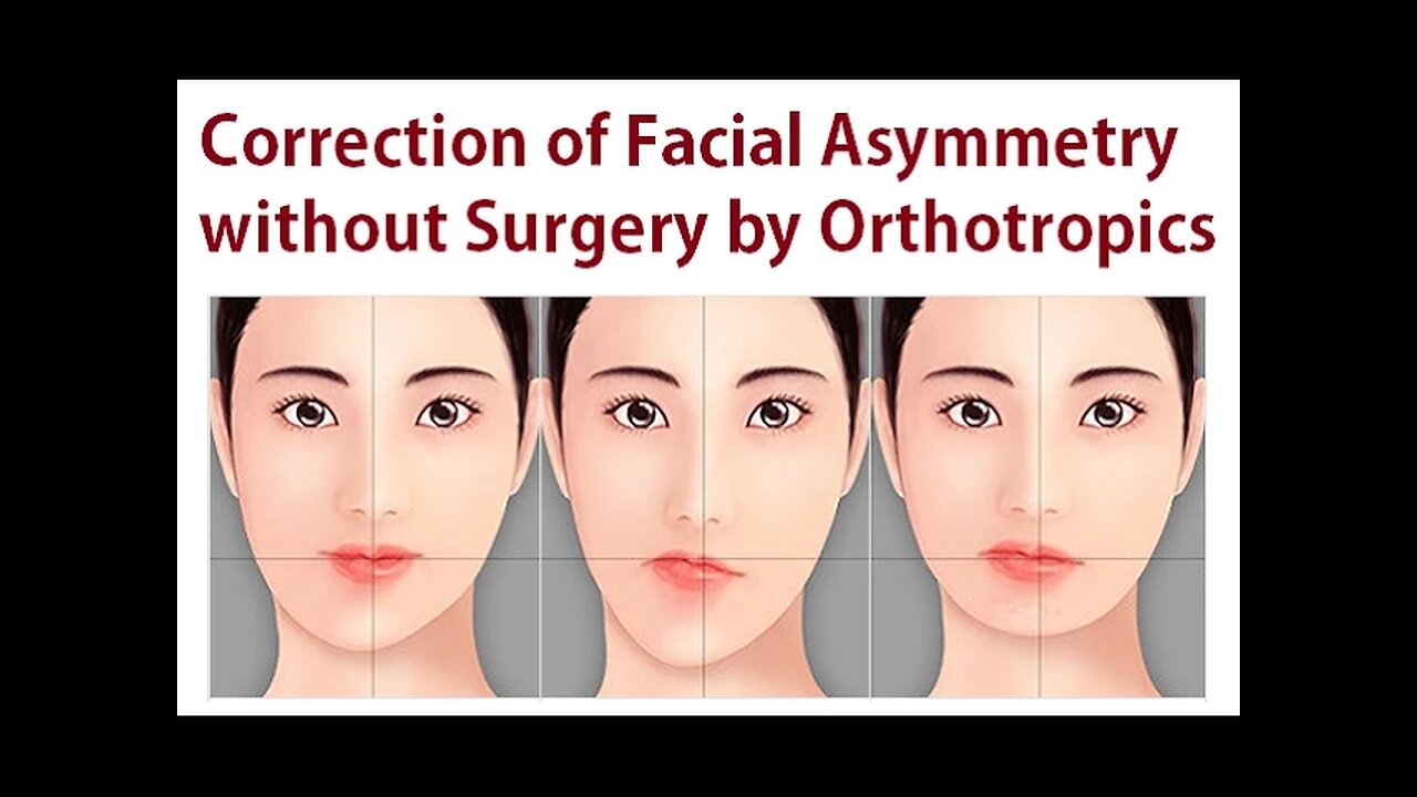 Correction of Facial Asymmetry Without Oral Surgery Using Orthotropics ...