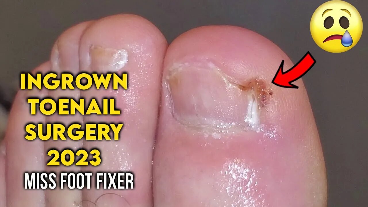 Ingrown Toenail Surgery 2023 [ Cutting Out Nail ] Full Treatment By ...