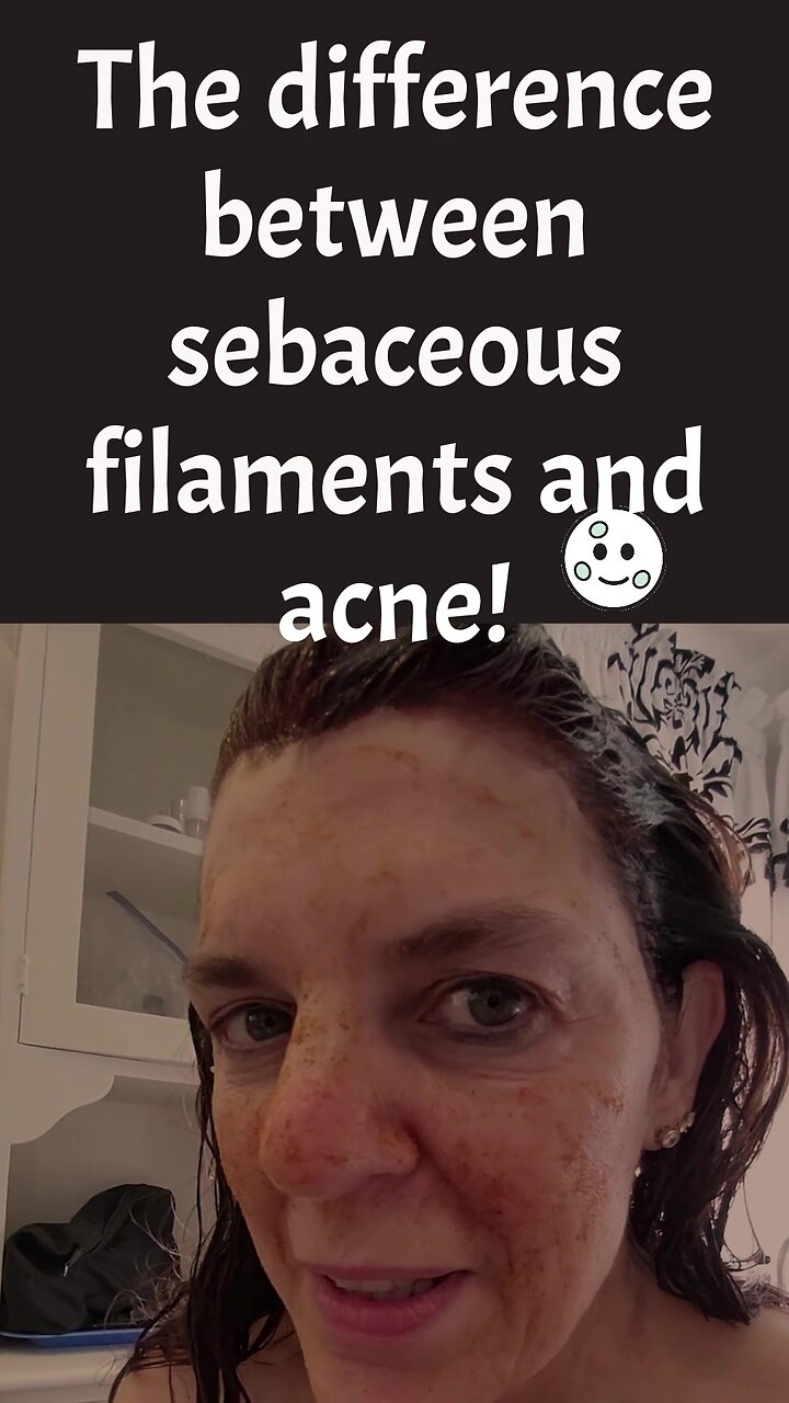 Acne Vs Sebaceous Filaments Vs Blackhead The Difference