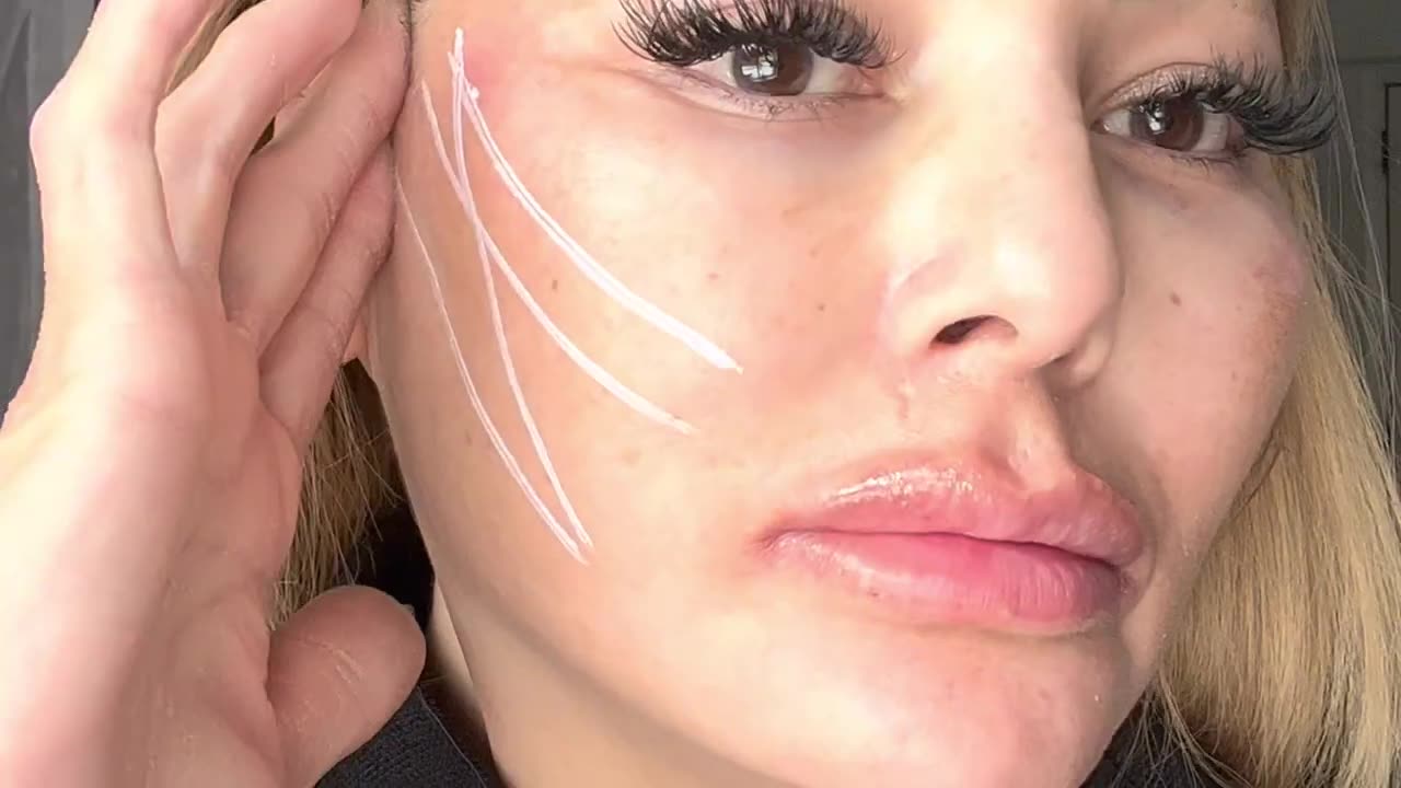 Cheek Bone Lift Using 2 Double Hooks