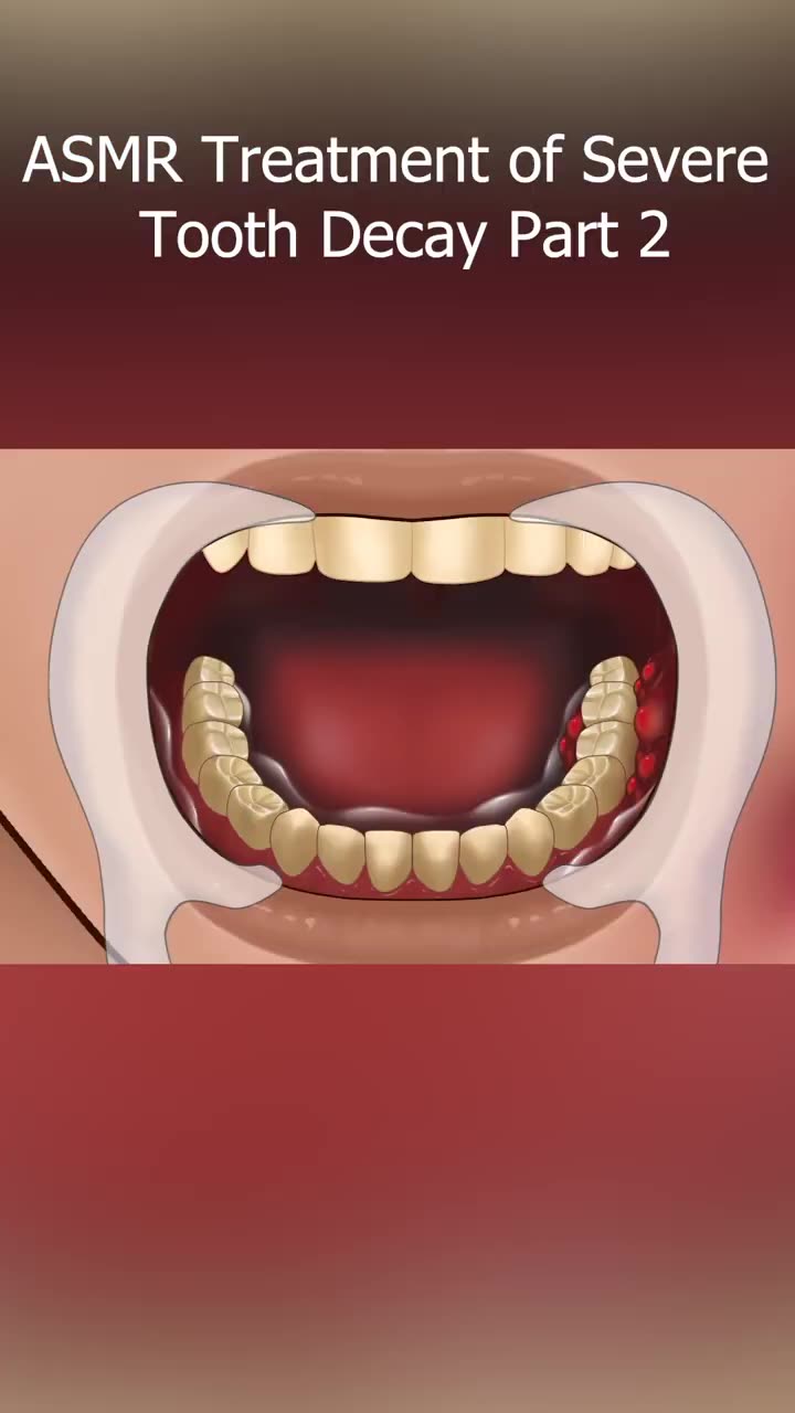 ASMR Treatment of Severe Tooth Decay so Satisfying