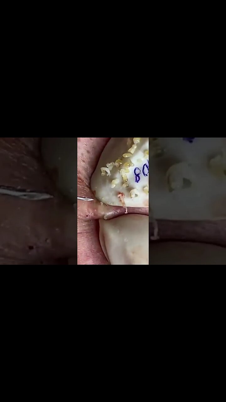 blackhead removal, blackheads, blackheads and acne, pimples removal, # ...