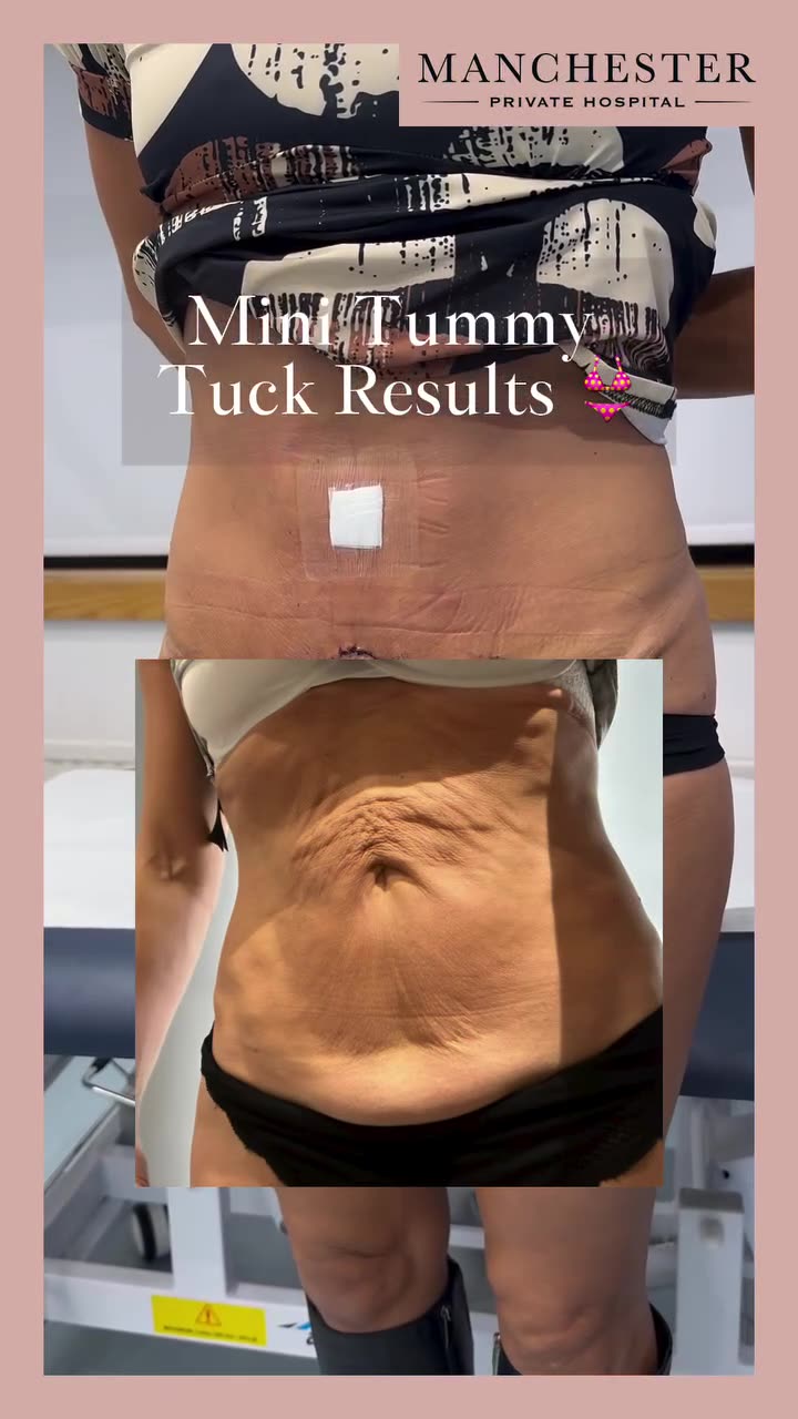 Mini Tummy Tuck Surgery Before and After | Stunning Transformation