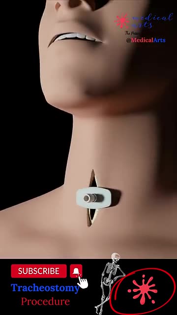 Tracheostomy 3d animation