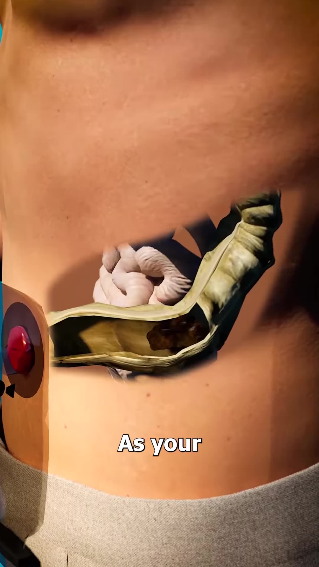What Exactly Is a Stoma? | Understanding How This Medical Solution Works