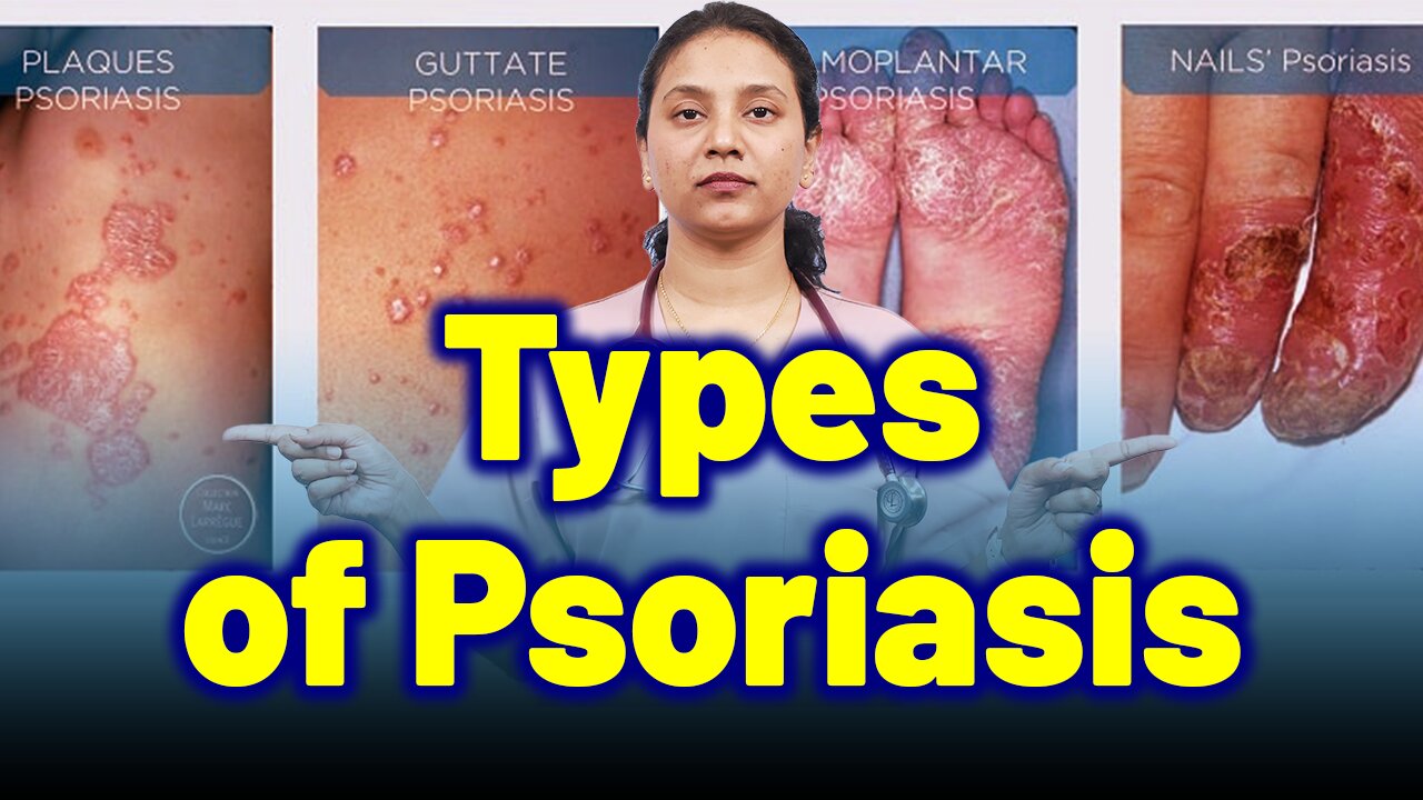 Types in Psoriasis | Treatment Cure Relief Medicine | Skin Hair Nail ...