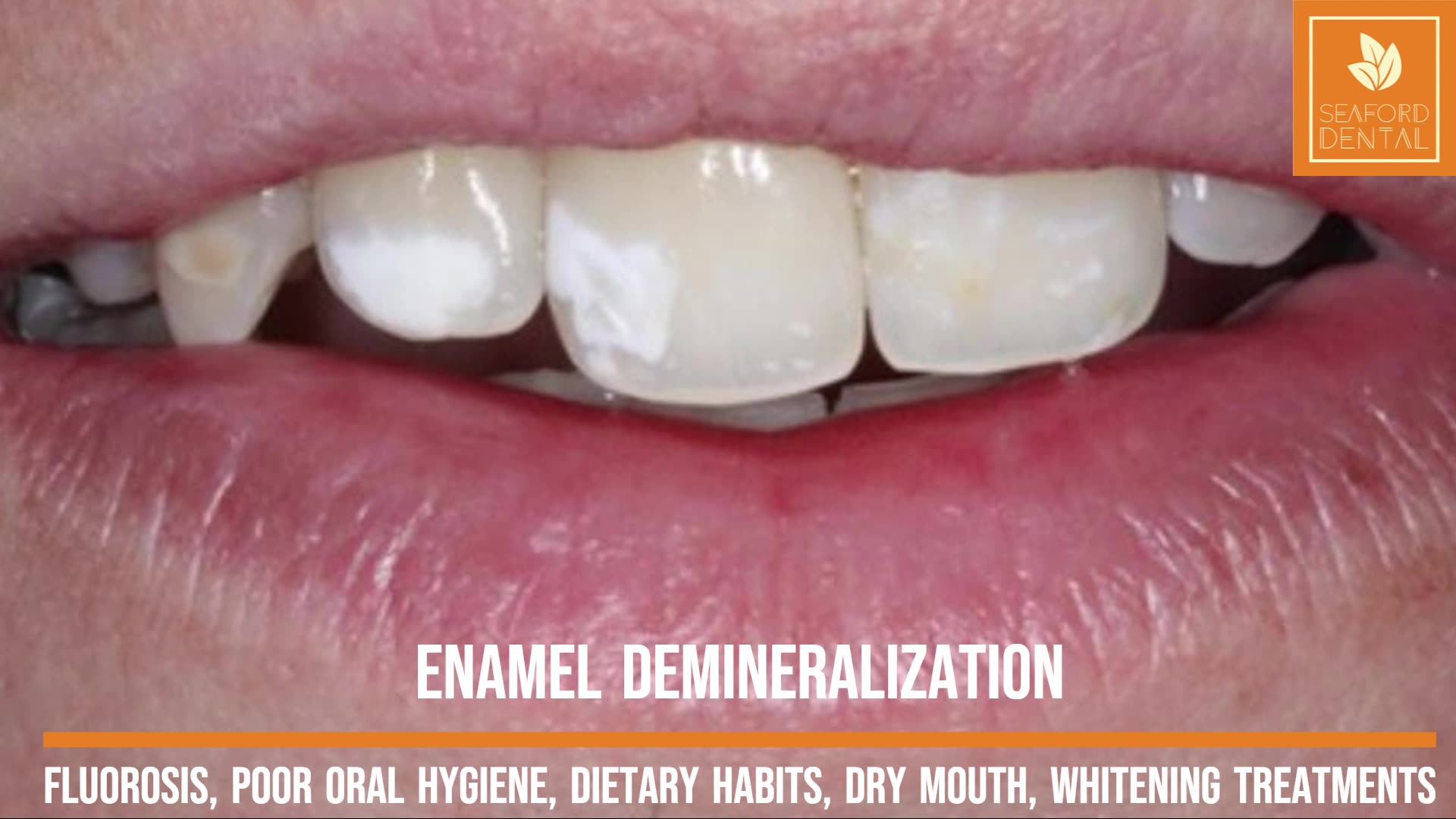 White Spots on Teeth: Causes and What You Can Do About Them