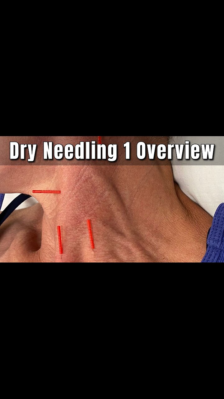 Dry Needling Courses for Healthcare Providers