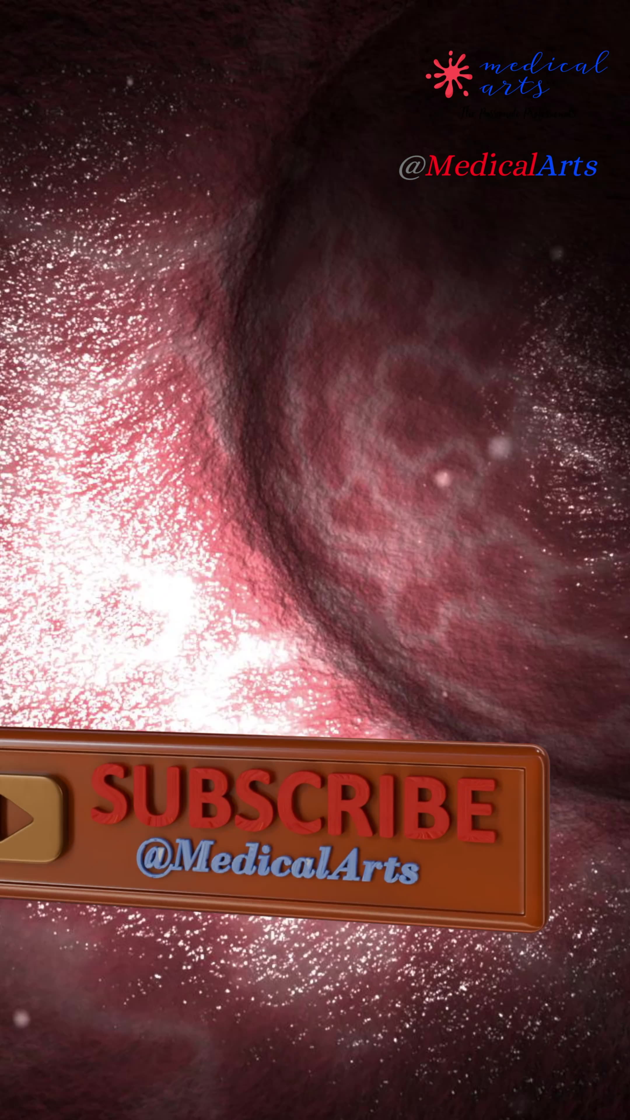 Colonoscopy Footage ₼ Watch This Polyp Removal