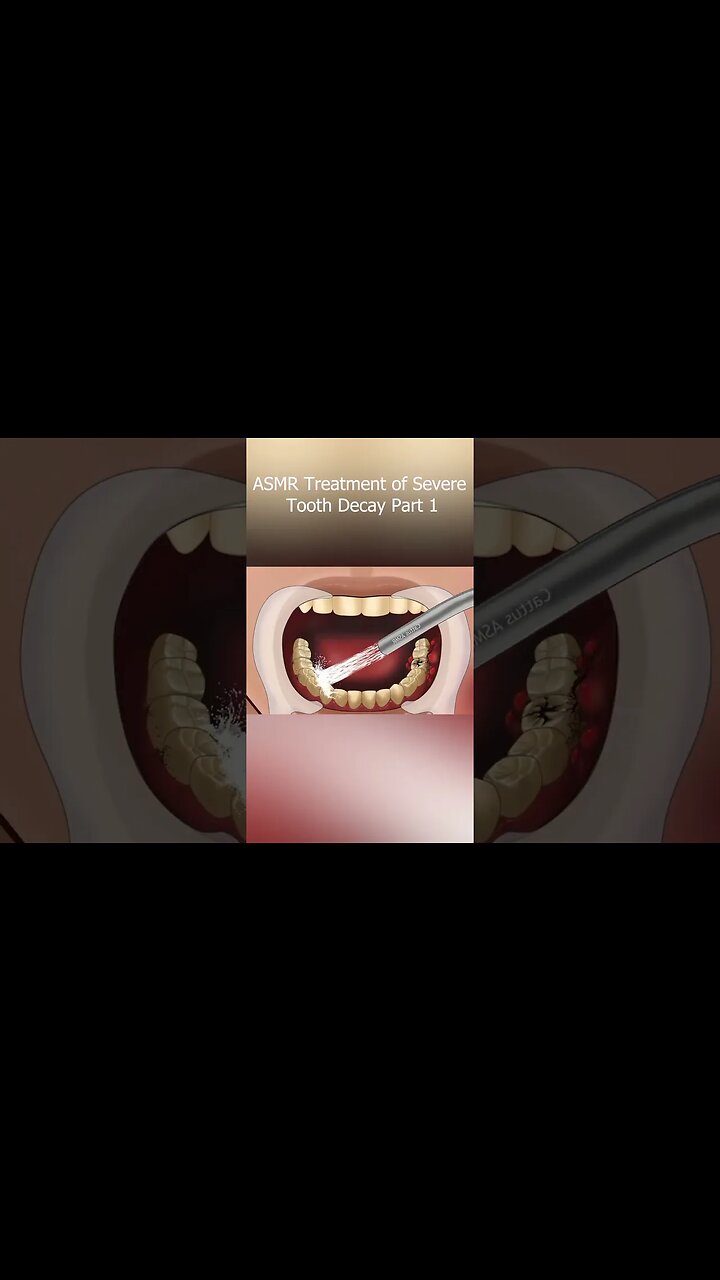 SATISFYING ASMR ( TREATMENT OF SEVERE TOOTH DECAY) @Satisfying_ ASMR ...