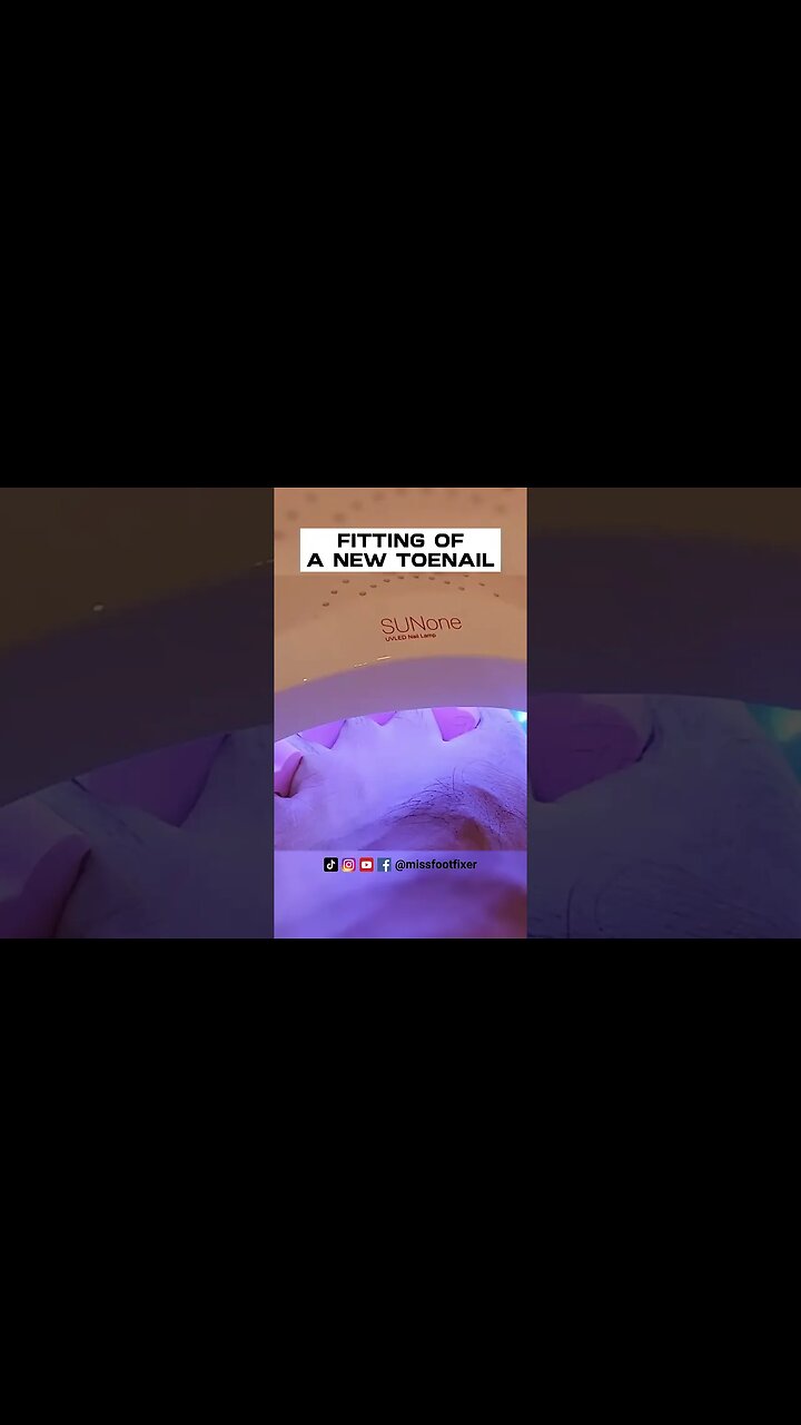 FITTING OF A NEW TOENAIL AFTER DOING FUNGAL NAIL TREATMENT BY FAMOUS ...