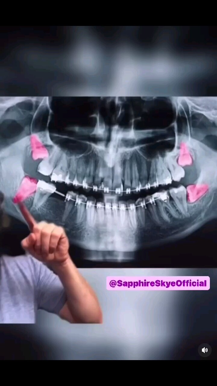 WISDOM TEETH What Teeth Reveal About Your Health. Each tooth in the ...