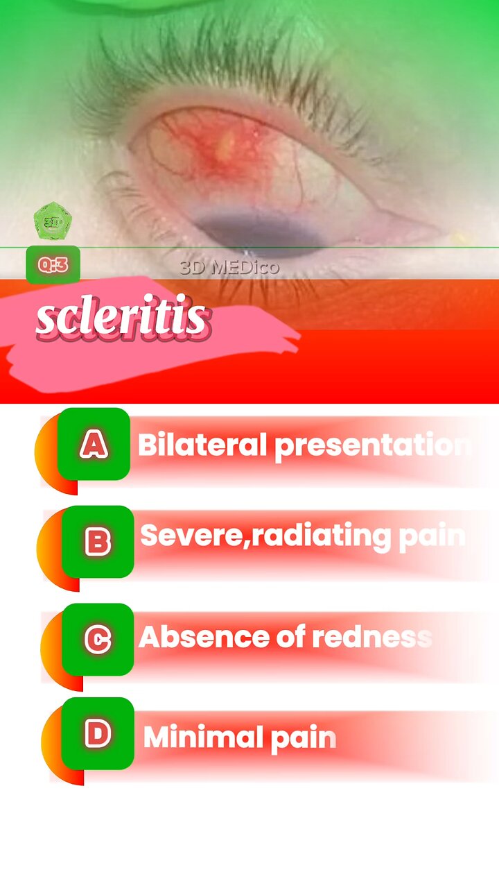 Scleritis question answers mcqs #Scleritis #posteriorScleritis # ...