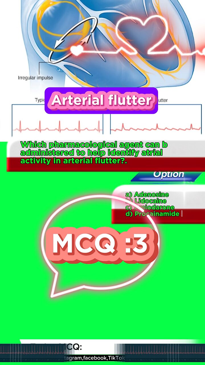 Arterial flutter #flutter -#arterialflutter #arrthythmia # ...