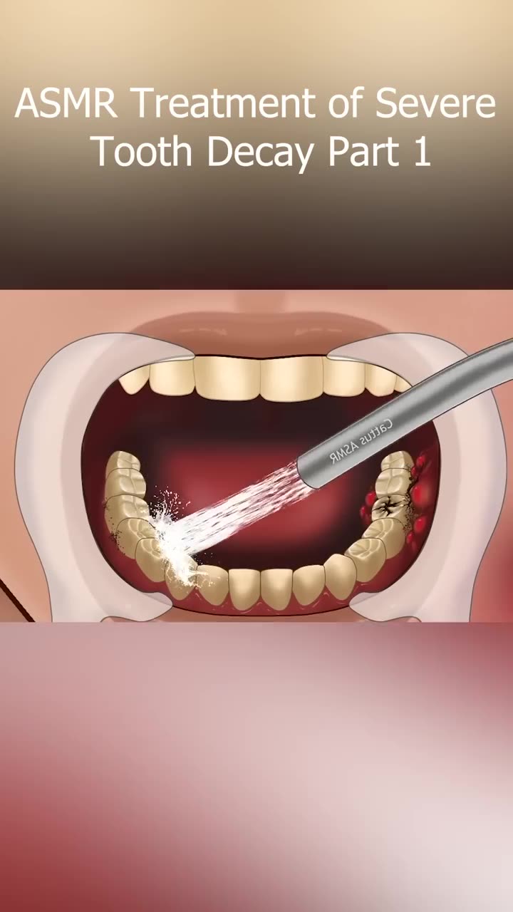 ASMR Treatment of Severe Tooth Decay