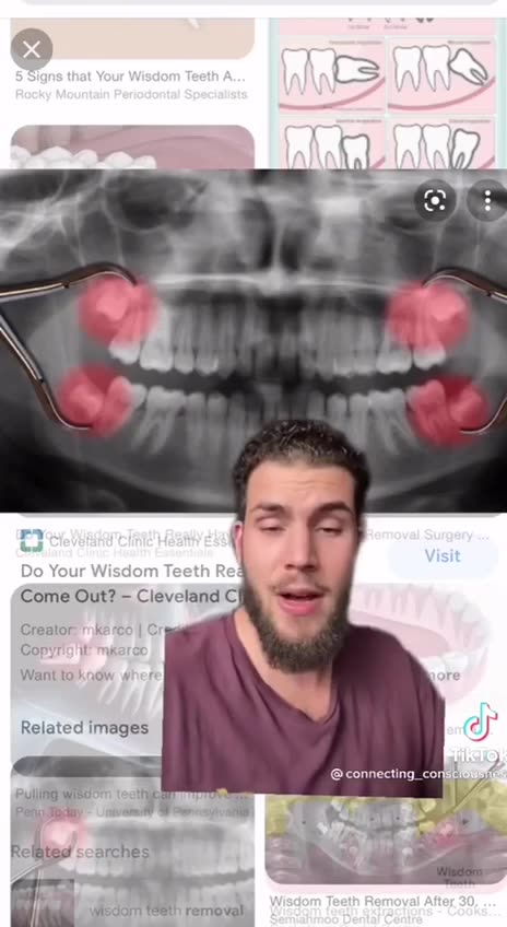 TRUTH ABOUT WISDOM TEETH REMOVAL..ROOT CANALS & THE PINEAL