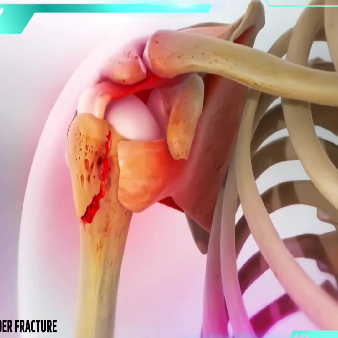 Types of Bone Fracture 3D Animation