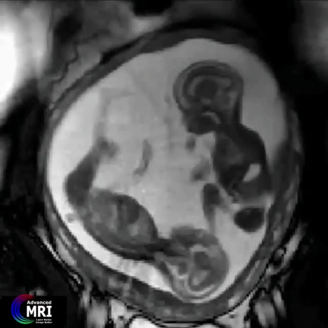 Mri fetal scan twin pregnancy ☢️♥🥰