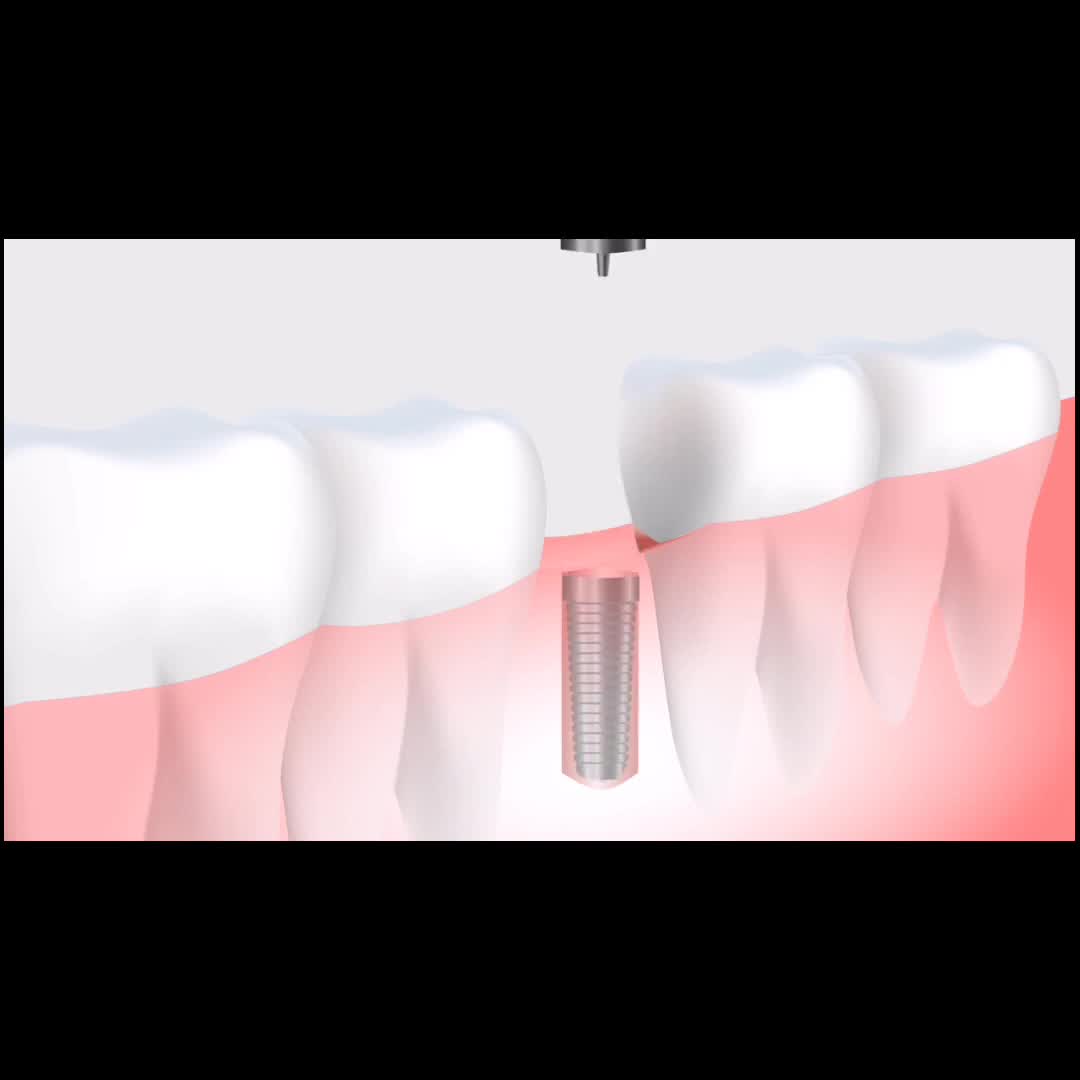 How to do Tooth Implant || how do tooth Implant || H4R