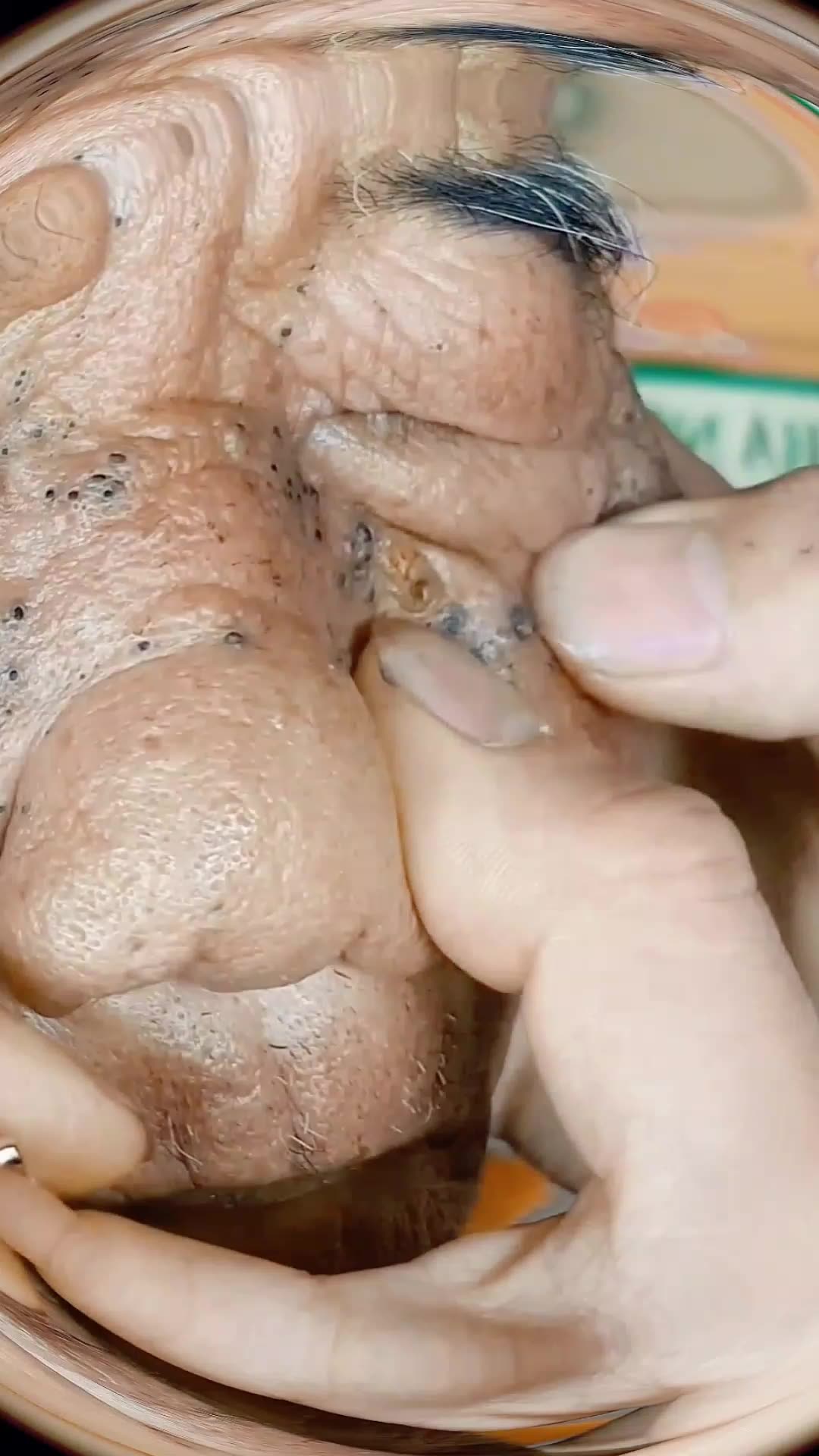 Asmr Old man face pimple