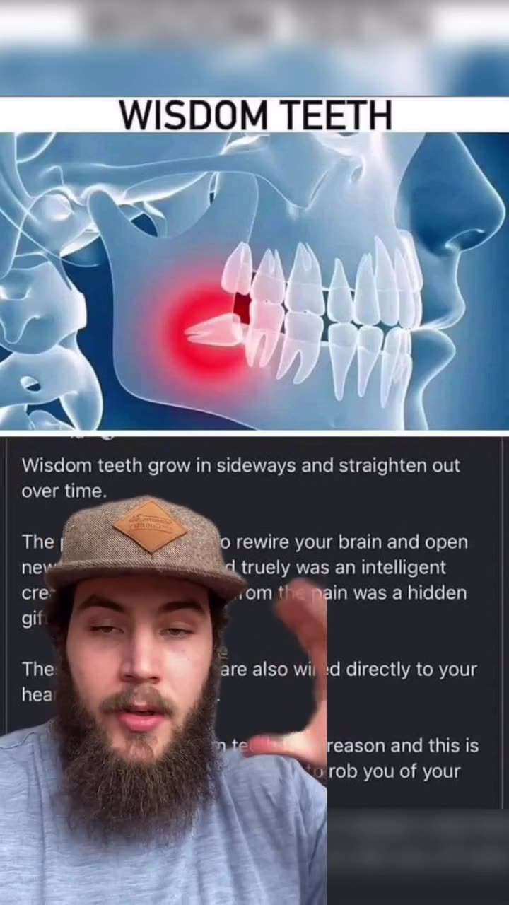 THE REAL REASON WHY WISDOM TEETH GET REMOVED
