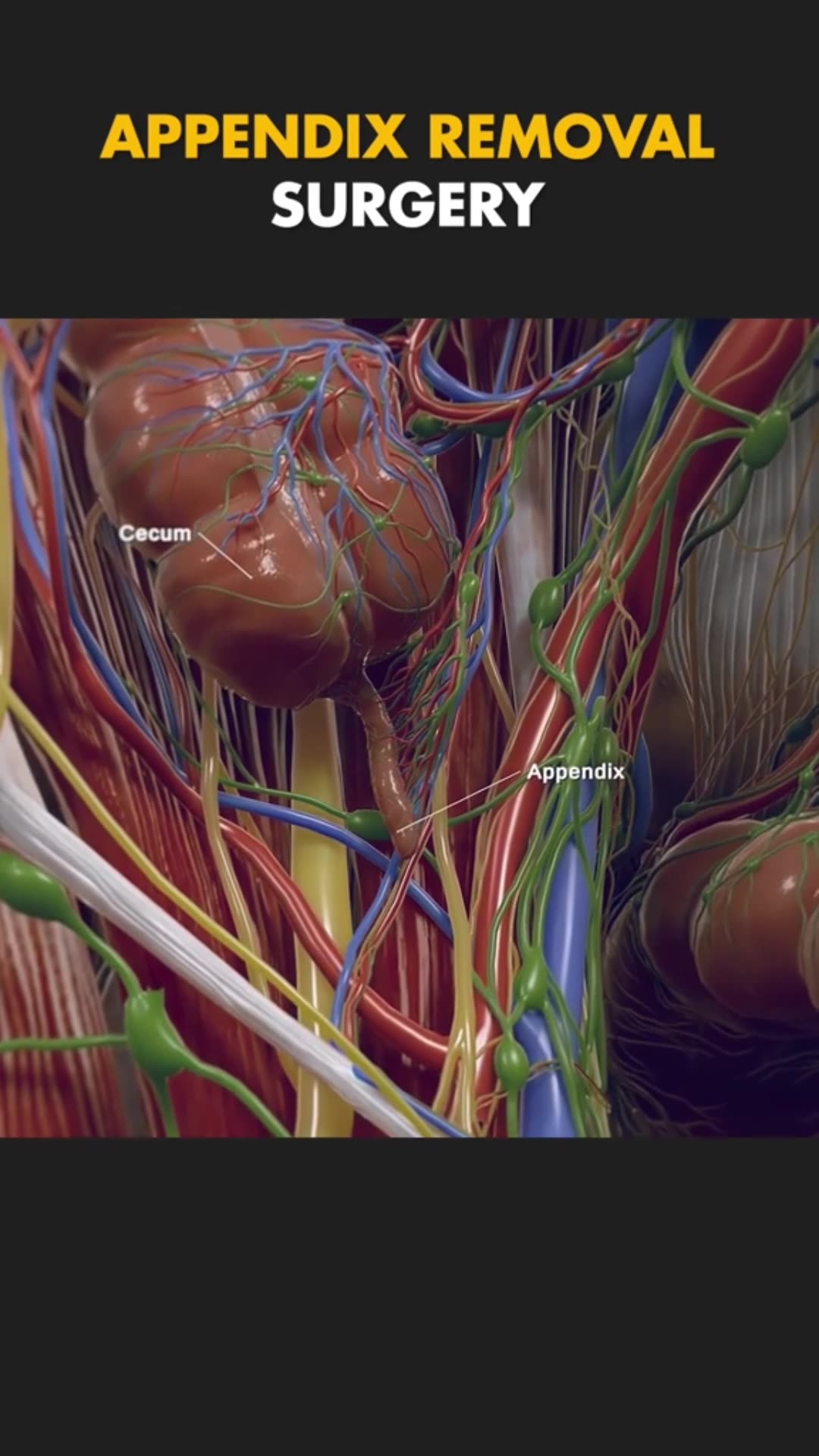 Appendix Removal Surgery😨🩺#Appendix #surgery #health #life