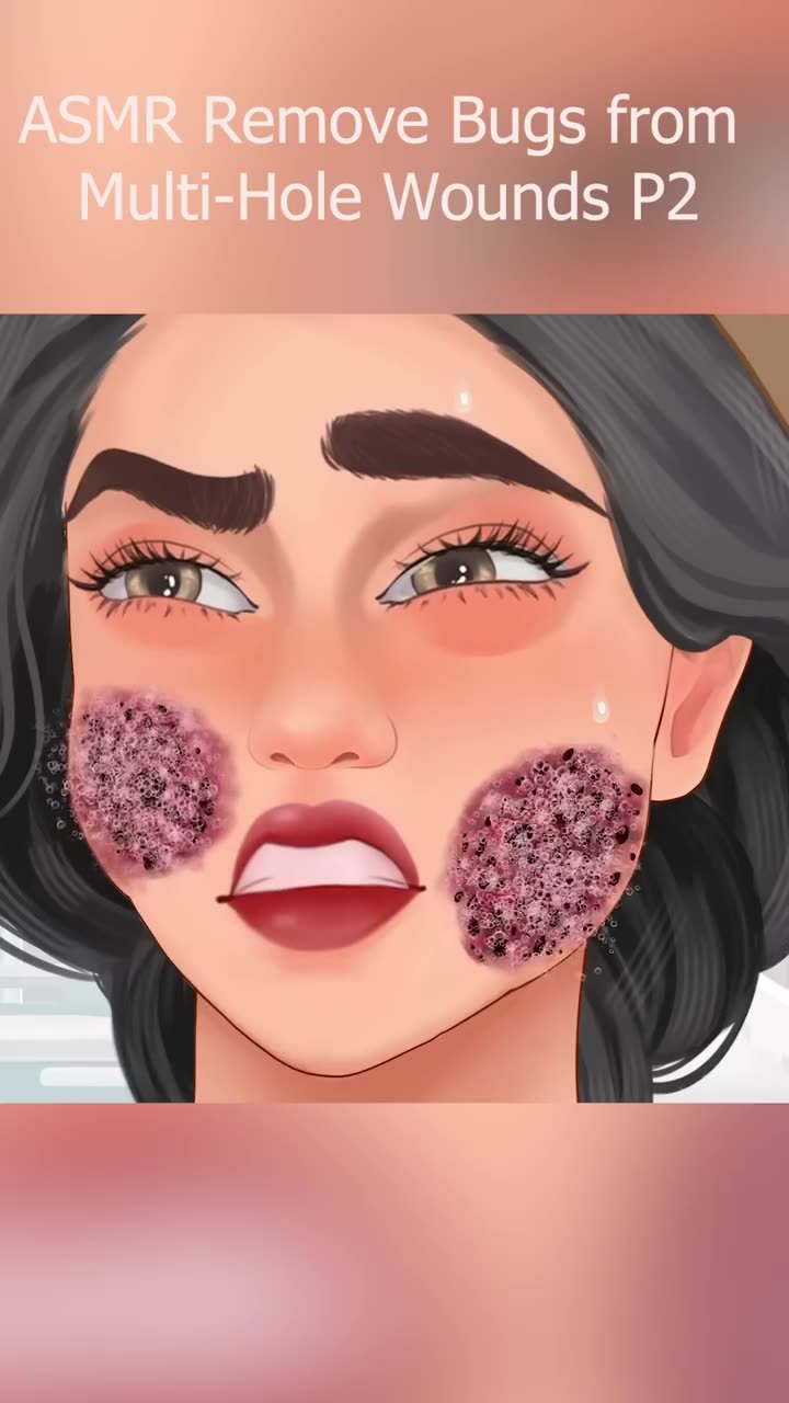 ASMR - Gentle Bug Removal from Multi-Hole Wounds 😱😱 Must-See Ending! # ...