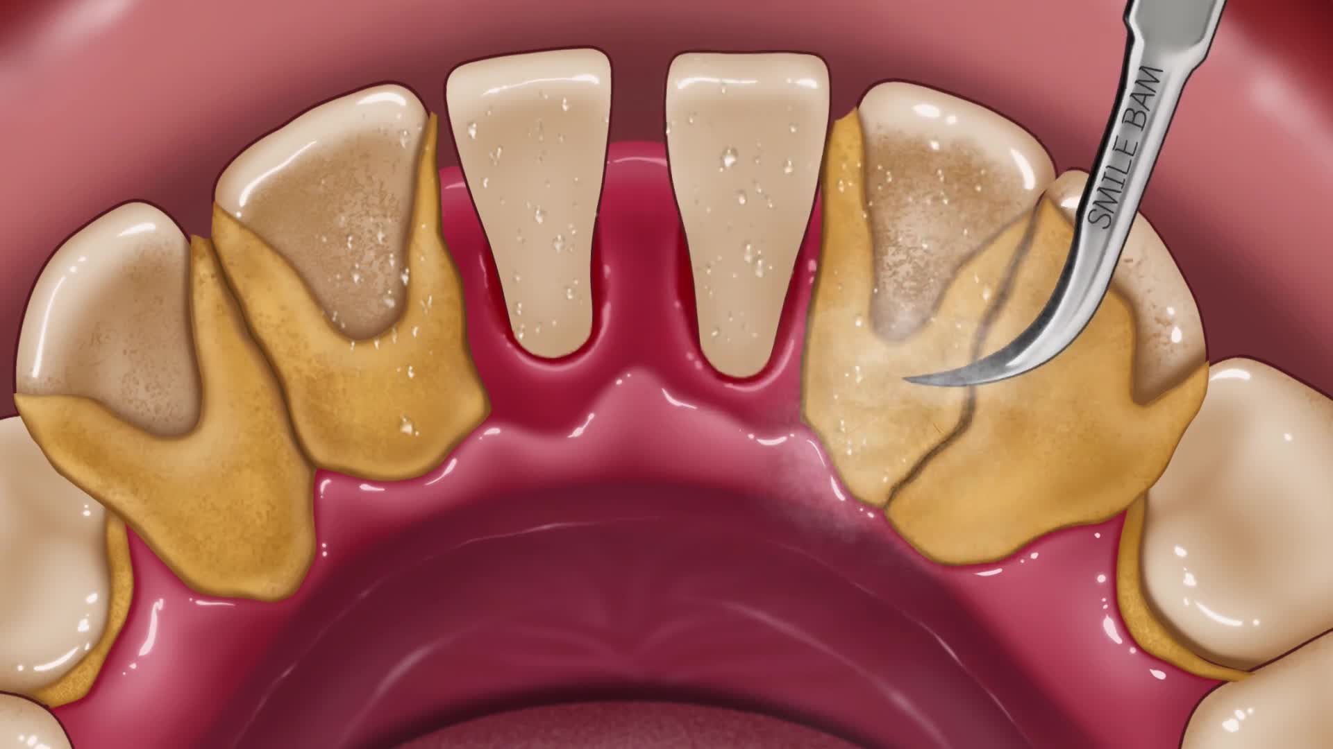 ASMR Extreme Tonsil Stone Treatment & Giant Tartar Removal Animation ...