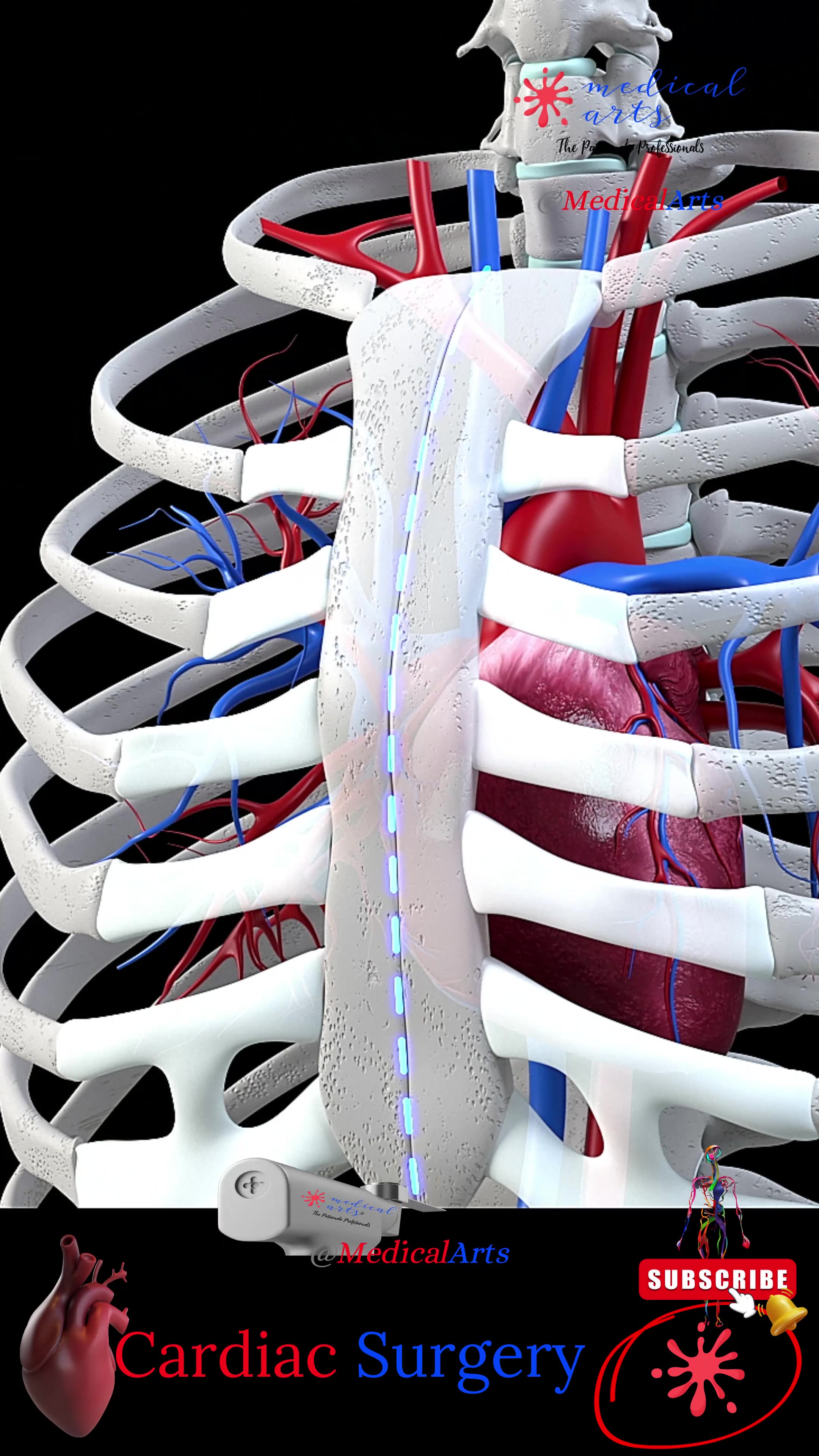 Open Heart 🔪 Cardiac Surgery ╭ ️～ Heart Bypass || 3D Medical Animation