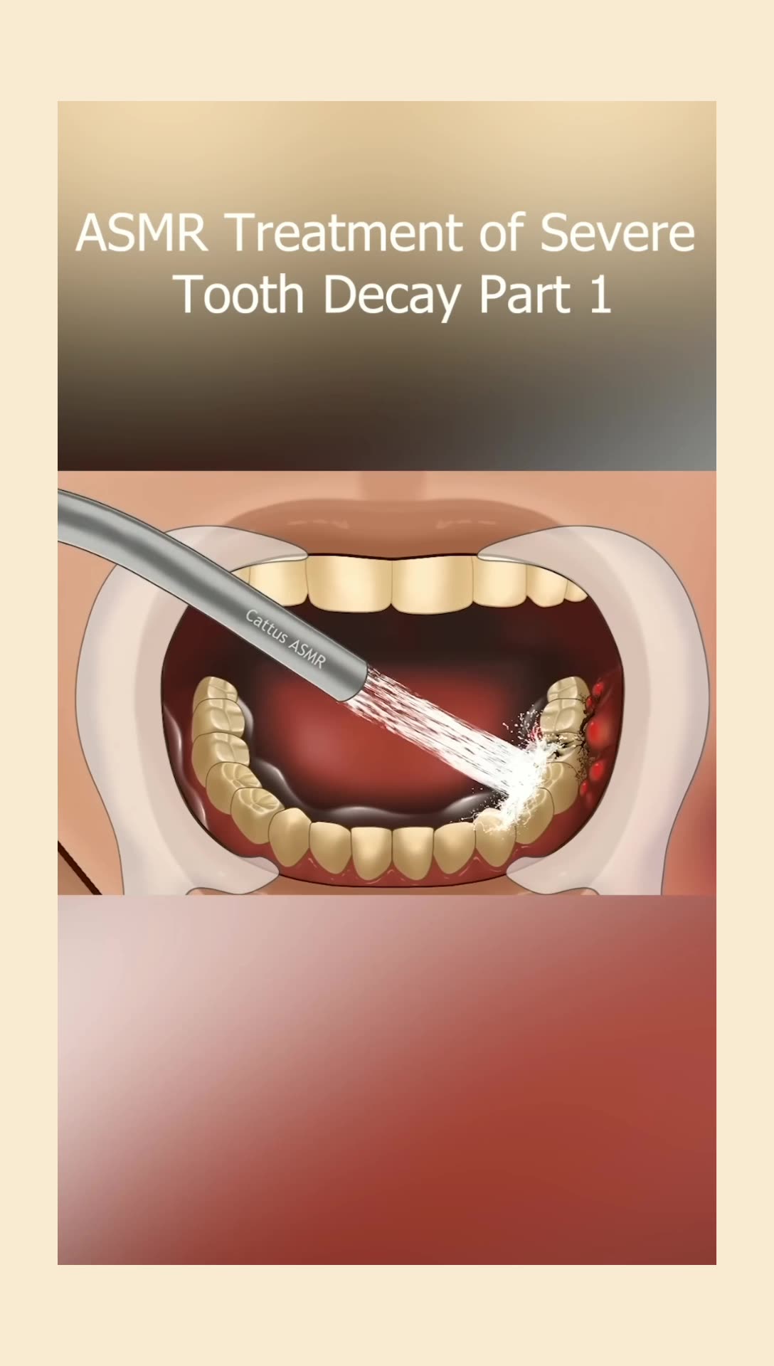 ASMR Treatment of Severe Tooth Decay